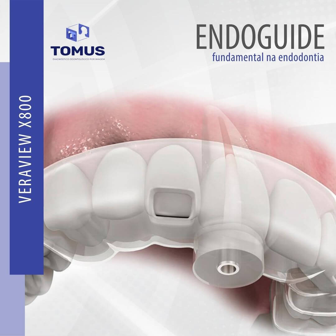 ENDOGUIDE: FUNDAMENTAL NA ENDODONTIA - Tomus