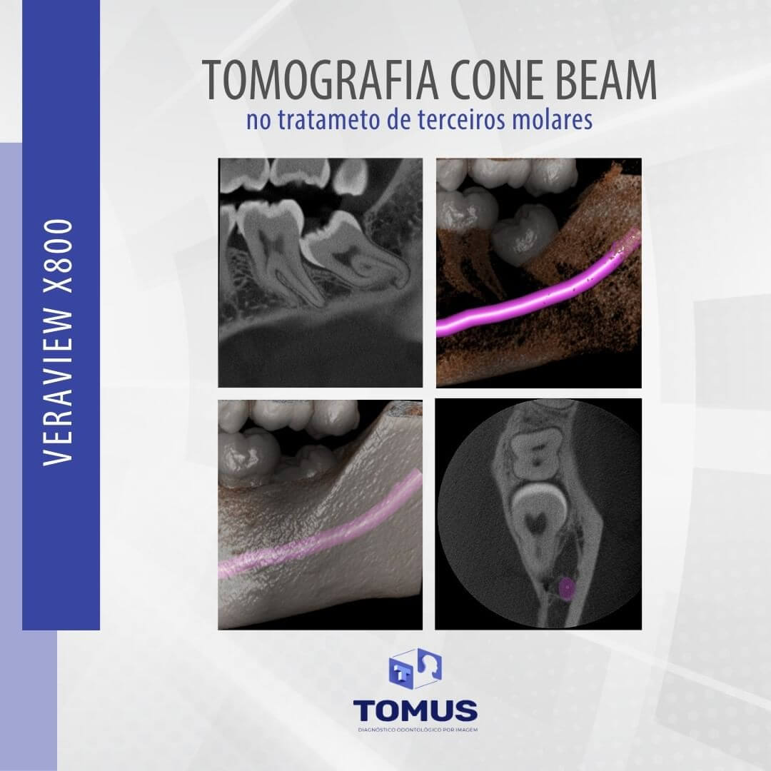 TOMOGRAFIA CONE BEAM - Tomus