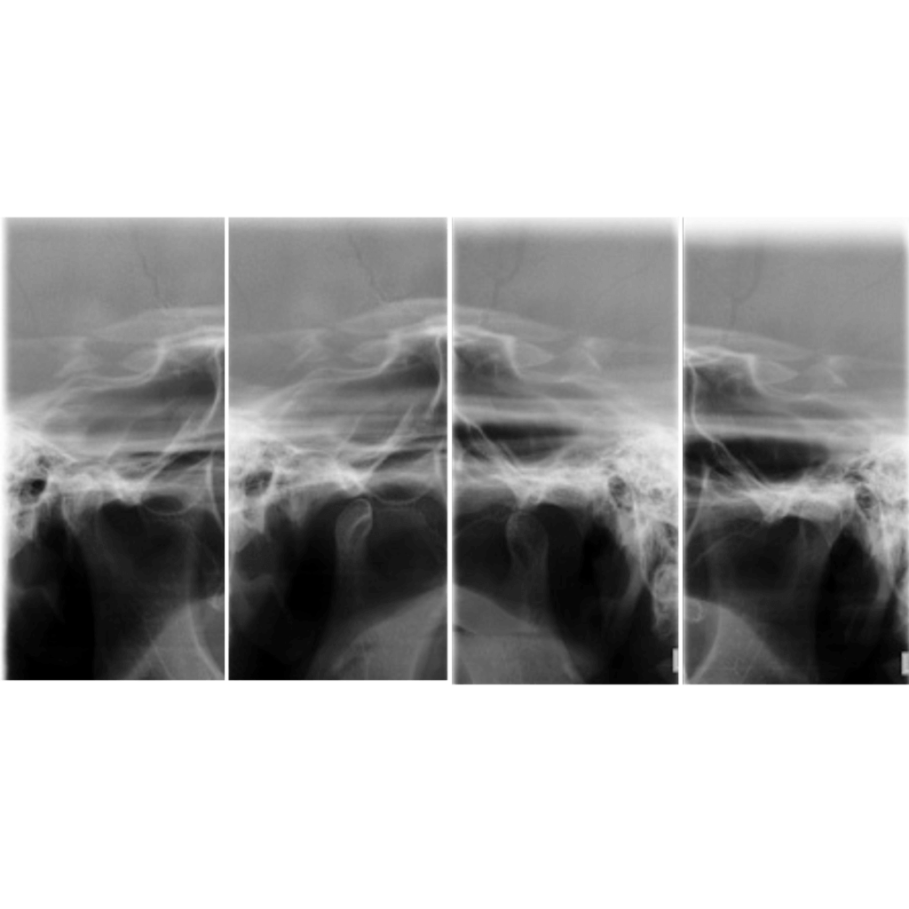 RADIOGRAFIA DE ATM - Tomus